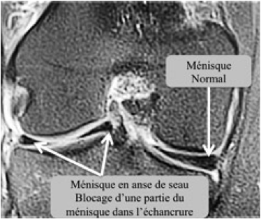 chirurgie méniscale